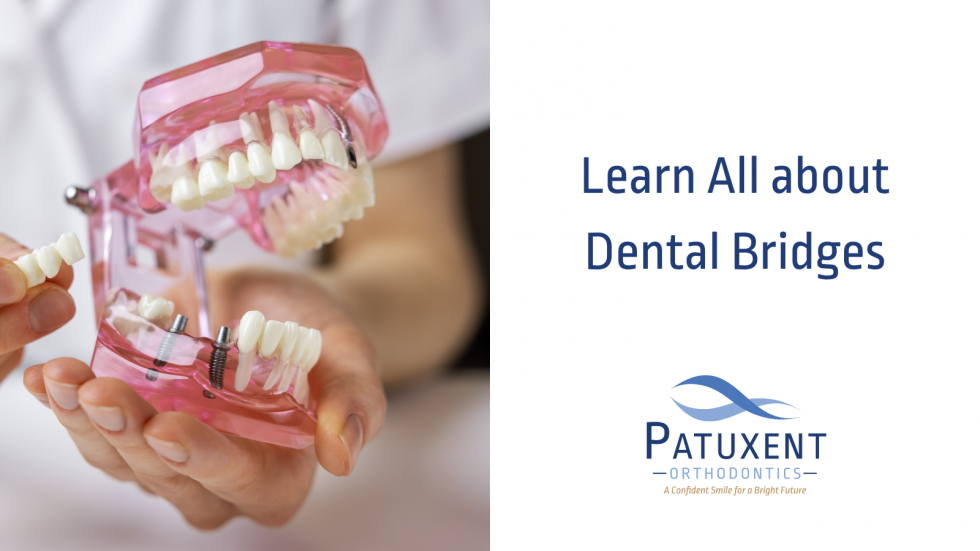 Learn All About Dental Bridges!