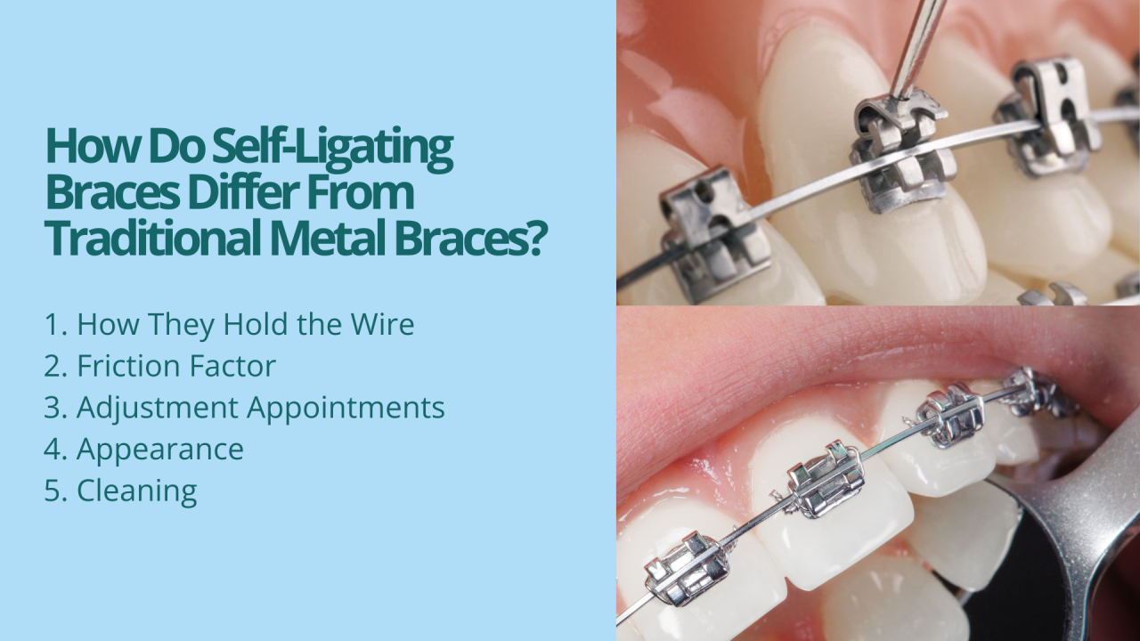 The Role of Self-Ligating Braces in Your Orthodontic Treatment