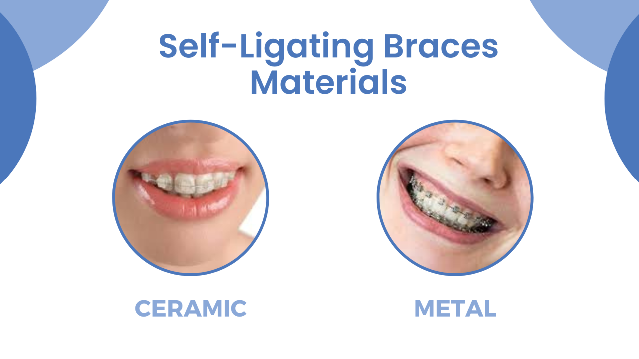 The Role of Self-Ligating Braces in Your Orthodontic Treatment