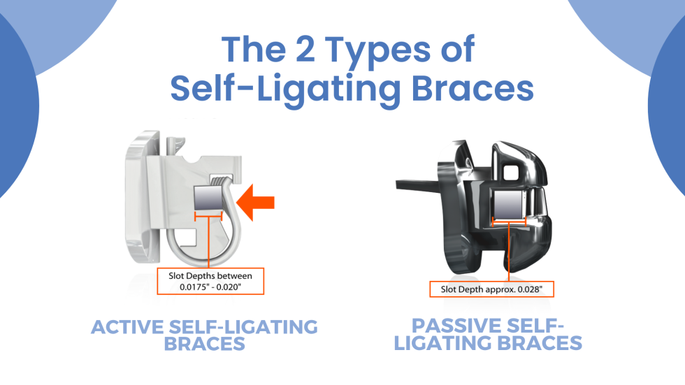The Role of Self-Ligating Braces in Your Orthodontic Treatment