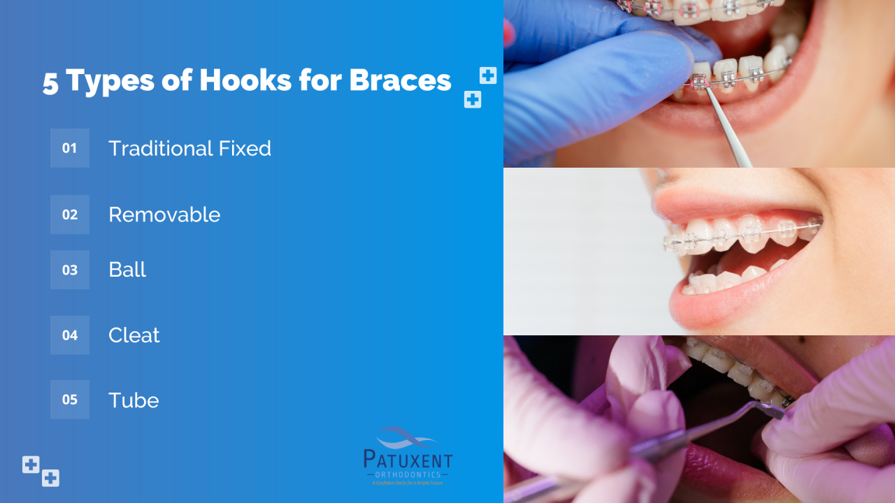 What Are The Hooks On Braces For