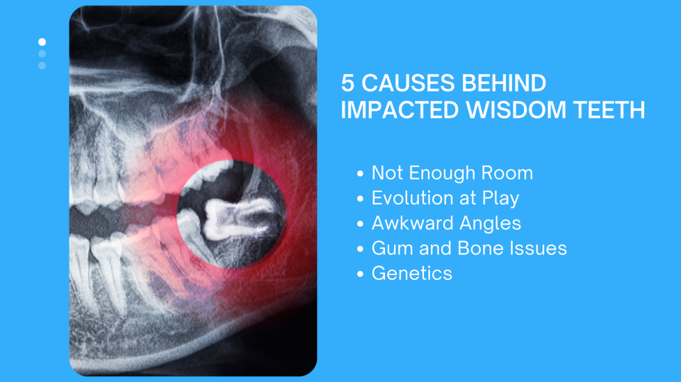 Impacted Wisdom Teeth: Symptoms and Treatment Options