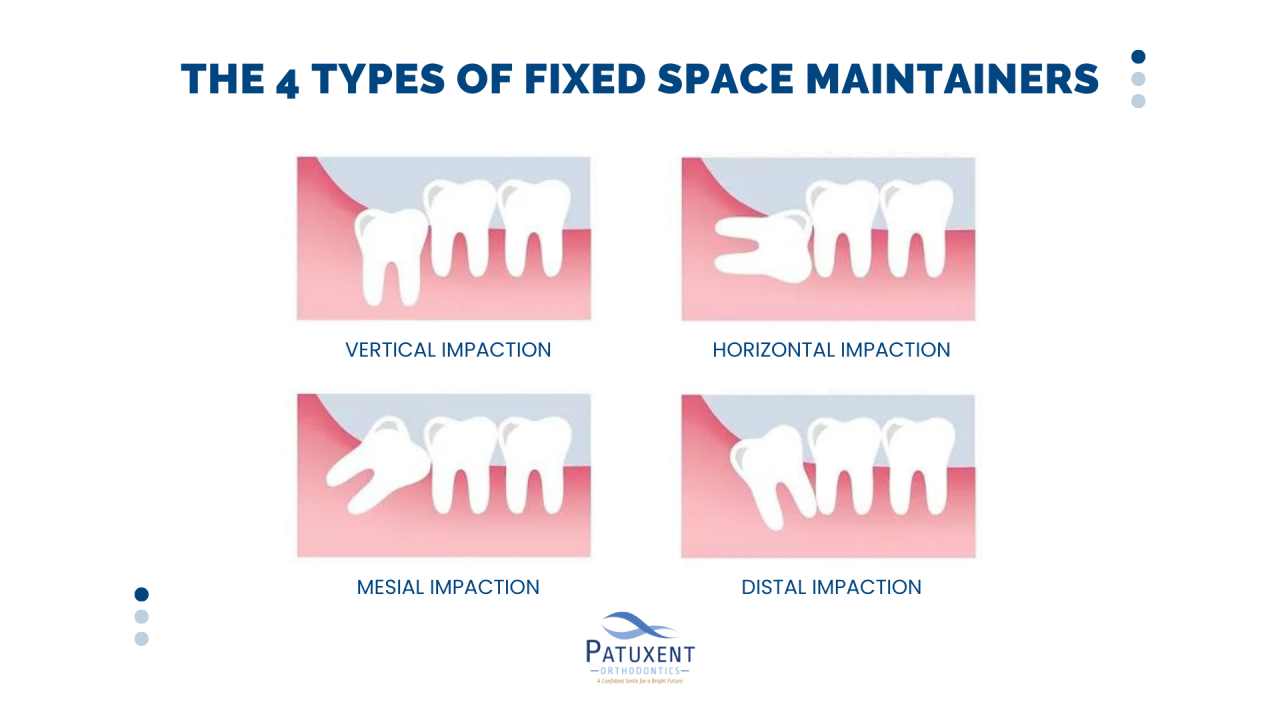 Impacted Wisdom Teeth: Symptoms and Treatment Options