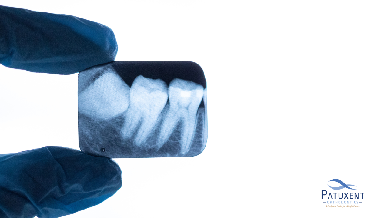 Do All People Have Wisdom Teeth?