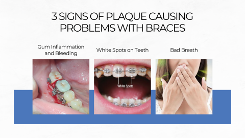 I've Noticed Heavy Plaque on My Braces: What to Do?