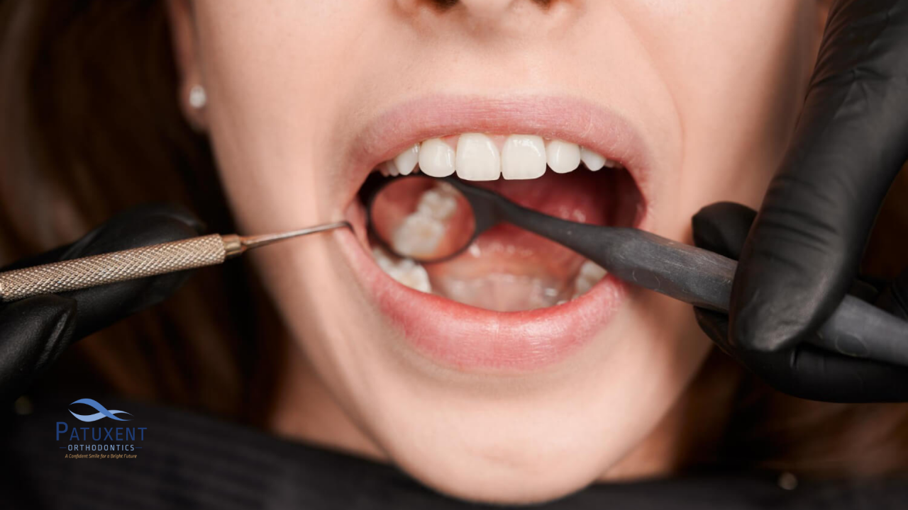 Can Wisdom Teeth Fall Out on Their Own?