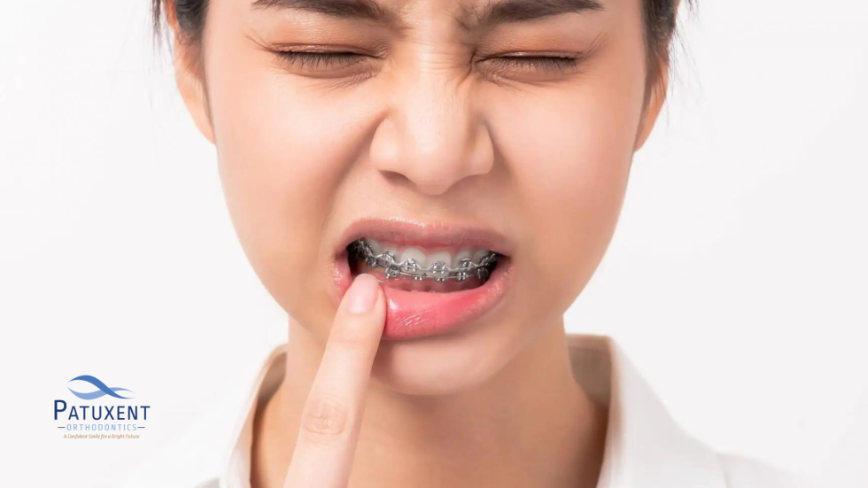 Canker Sores from Braces