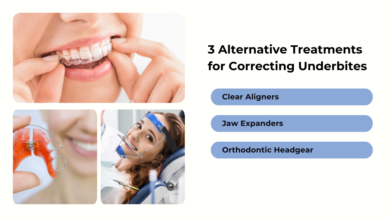The Role of Braces in Treating Underbites
