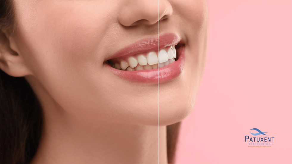 Tooth Extraction for Braces: Pros and Cons
