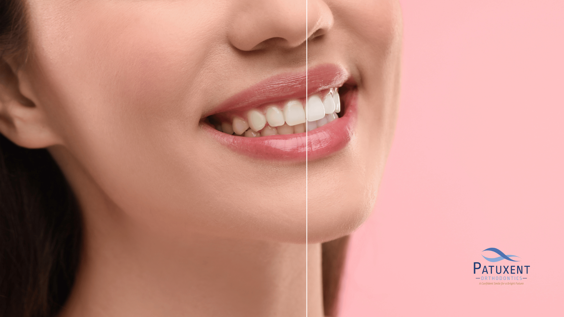 11 Causes of Tooth Discoloration